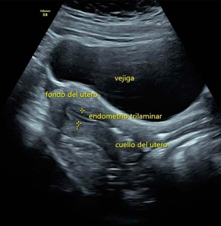 Paso a Paso de Inseminación Intrauterina – Dra. Bagnarello